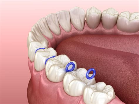 Dental Spacers In Clarksville Pleasant View TN