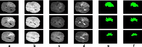 figure 1 from brain tumor segmentation and classification using cascaded random decision forests