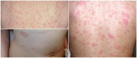 Pityriasis rosea sur le vagin afro américain Belles photos érotiques