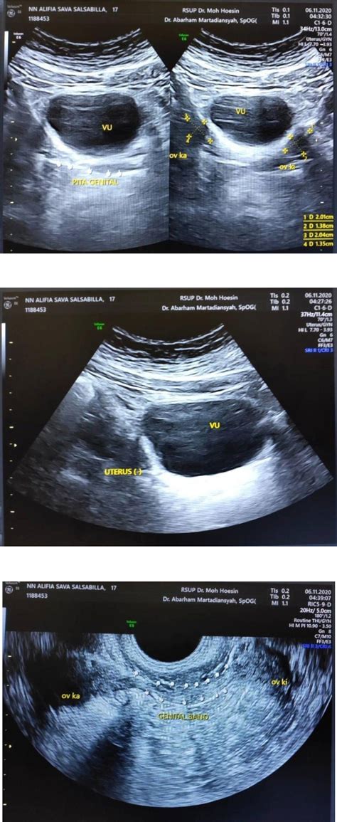 Figure 3 From Laparoscopic Davydov Procedure For Creation Of Neovagina
