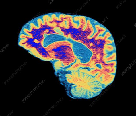 Multiple Sclerosis Brain MRI Stock Image M210 0188 Science Photo