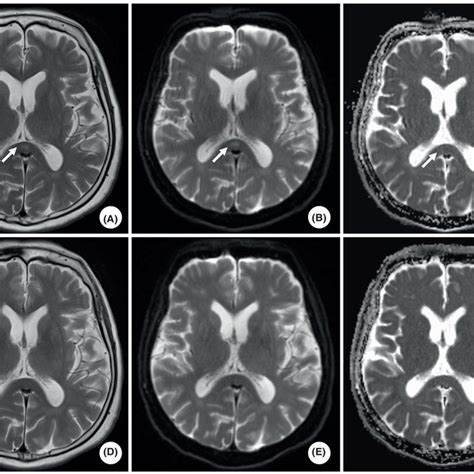 Brain Mri Of This Case T Wi A And Diffusionweighted Imaging Dwi
