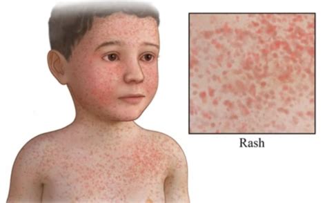 Campak Jerman Rubella Penyebab Gejala Penanganan Pencegahan Dan Dokter Spesialis Campak