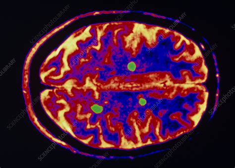 Col Mri Brain Scan Of A Multiple Sclerosis Patient Stock Image M2100068 Science Photo Library