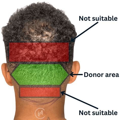 Using Hair From Non Safe Donor Area Hair Restoration Questions And