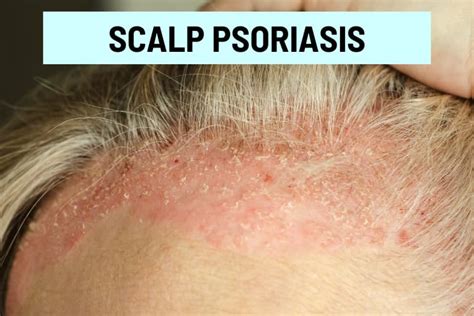 Red Spots On Scalp 11 Causes Pictures And Treatment