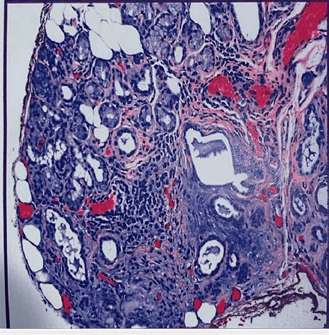 Lip Biopsy Minor Salivary Glands With Approximately One Focus Of Download Scientific Diagram