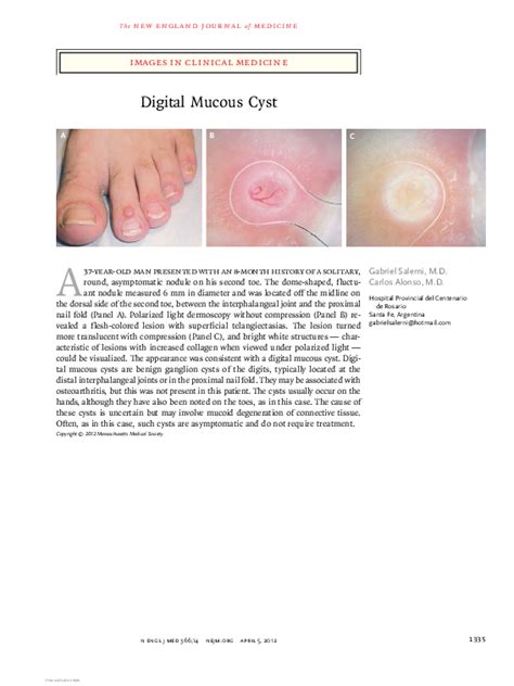Pdf Digital Mucous Cyst Gabriel Salerni