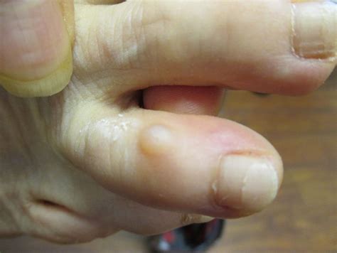 An Atlas Of Lumps And Bumps Part 21 Digital Mucous Cyst Consultant360