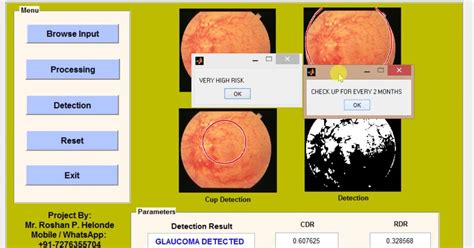 glaucoma detection using image processing matlab project with source code ~ matlab project codes