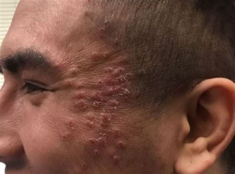 Derm Dx Rash On The Cheek And Scalp Clinical Advisor