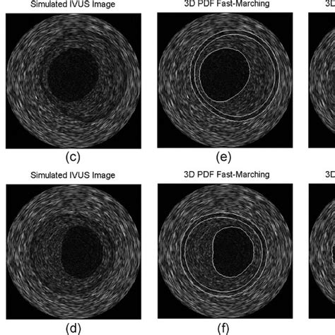 pdf intravascular ultrasound image segmentation a three dimensional fast marching method