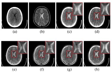 electronics free full text mri image fusion based on sparse representation with measurement