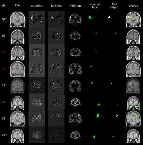 external validation of automated focal cortical dysplasia detection using morphometric analysis