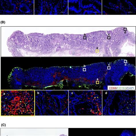 Phenotype And Distribution Of Tumorassociated Macrophages A Double