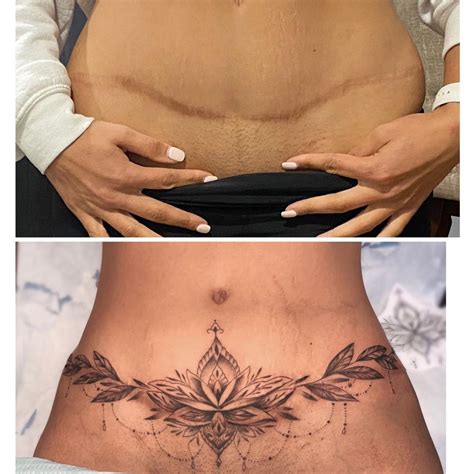 Aggregate 64 Tummy Tuck Tattoo Vn