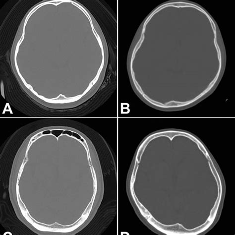 Representative Computed Tomography Scan Findings An Axial Computed