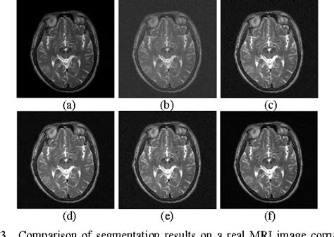 figure 3 from mri brain image segmentation based on kerneled fcm algorithm and using image
