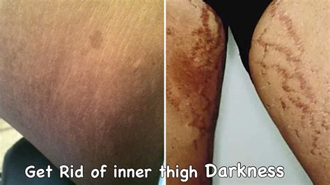 Ingrown Hair Scars On Thighs Marg Heath