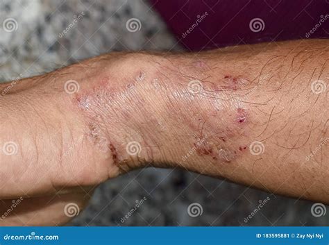 Tinea Infection At Scalp It Is A Fungal Infection That Causes Scaly And Itching Royalty Free