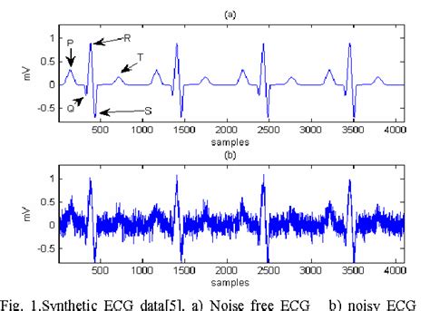 figure 1 from ecg denoising using modulus maxima of wavelet transform semantic scholar