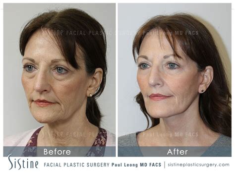 Blepharoplasty Before And After 26 Sistine Facial Plastic Surgery