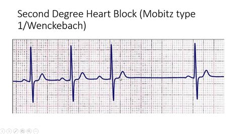 Heart Block Types Ecg