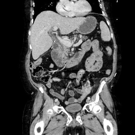 Acute Cholangitis Radiology Reference Article Radiopaedia Org