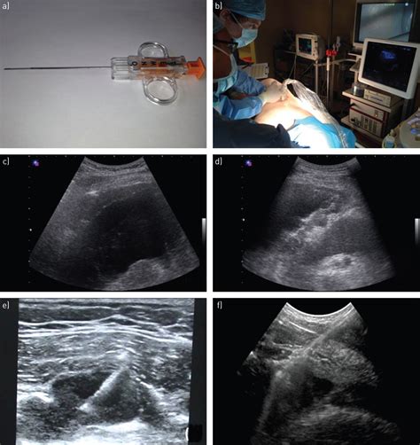 Advanced Medical Interventions In Pleural Disease European Respiratory Society