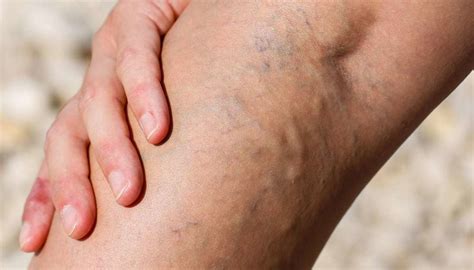 Varicose Eczema Or Stasis Dermatitis Symptoms Causes And Treatment