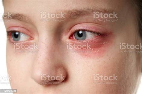 Allergic Reaction Skin Rash Close View Portrait Of A Girls Face Redness And Inflammation Of The