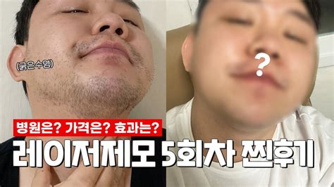 광고 수염 레이저 제모 5회차 찐후기 모든걸 알려드림 YouTube