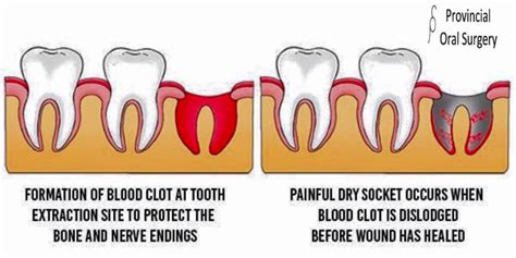 Dry Socket Causes Symptoms Diagnosis Treatment 42 OFF