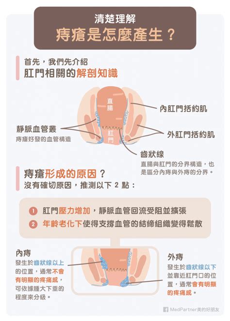 痔瘡怎麼辦如何預防與完整治療醫師圖文完整解說 美的好朋友