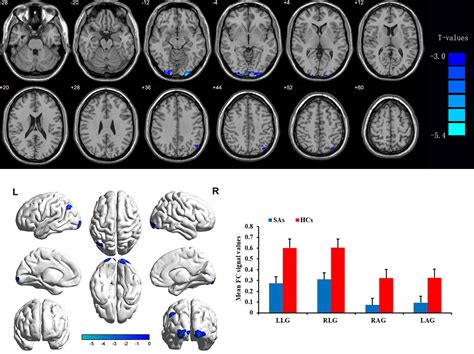 altered functional connectivity of primary visual cortex in adults with strabismus and amblyopia