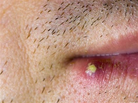 Here Are The Top 20 Stis And How To Avoid And Treat Them