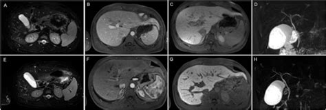 Clinical Features And MRI Progression Of Small Duct Primary Sclerosing
