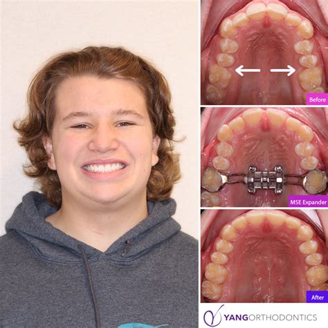 Lower Jaw Expander