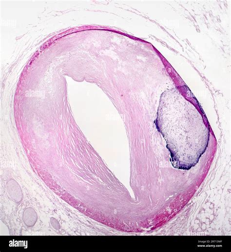 Vascular Calcification Light Micrograph Hematoxylin And Eosin