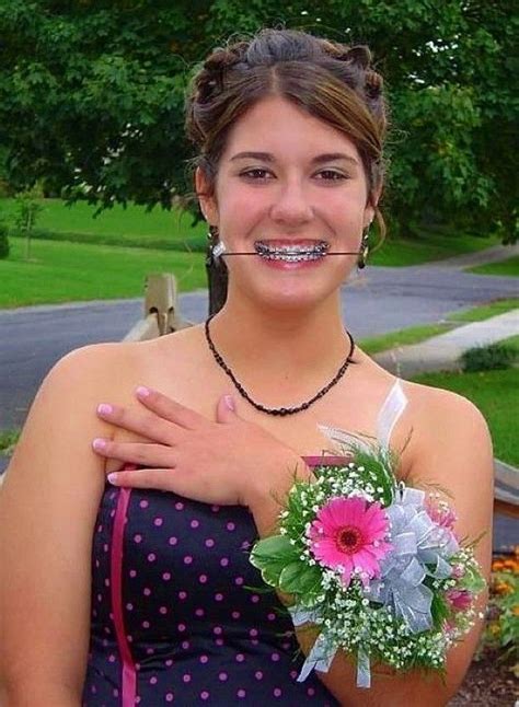 Pin Von Jamie Richie Auf Braces And Retainers Orthodontics Zahnspange Zähne