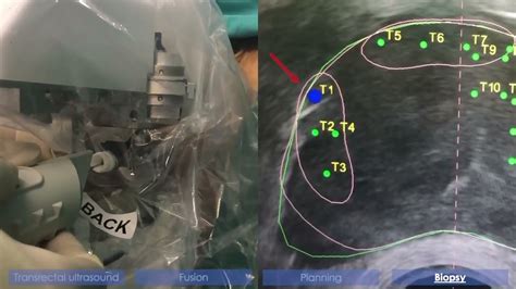 Robotic Mri Us Fusion Transperineal Prostate Biopsy Youtube