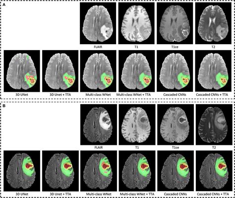 frontiers automatic brain tumor segmentation based on cascaded convolutional neural networks