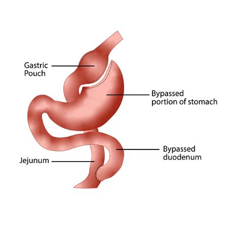 Cureus Bariatric Surgery With Roux En Y Gastric Bypass Or Sleeve Gastrectomy For Treatment Of