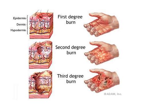 Difference Between St Nd And Rd Degree Burns
