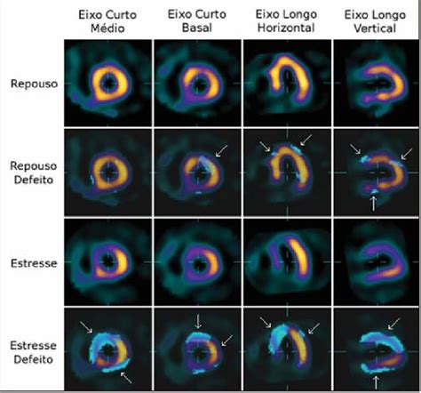 Tomographic Sections Representative Of Myocardial Perfusion SPECT Of A