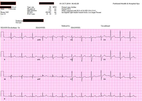 Printable Ekg Strips With Answers 2020 2021 Fill And Sign Printable