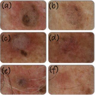 Dermatoscopic Images Taken With Digital Dermoscopy System VisioMed