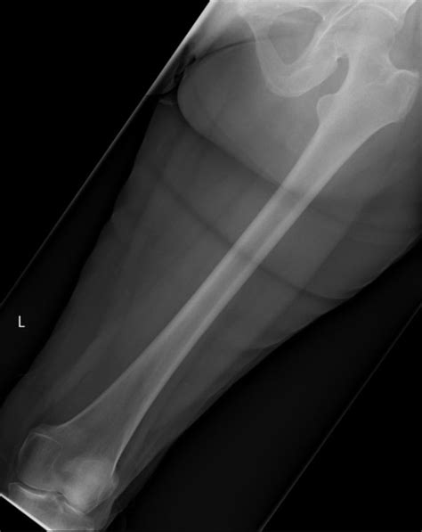 AP Femur Xray X Ray Natural Landmarks Med School