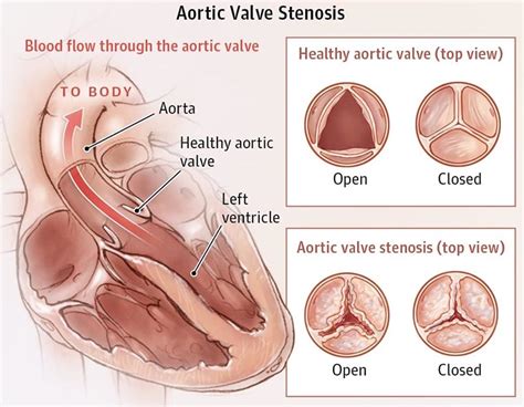 What Is Aortic Stenosis The Heart Vascular Centre