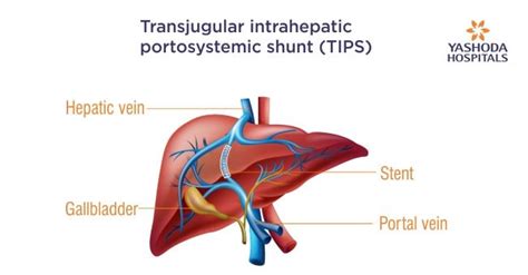Transjugular Intrahepatic Portosystemic Shunt Diagram